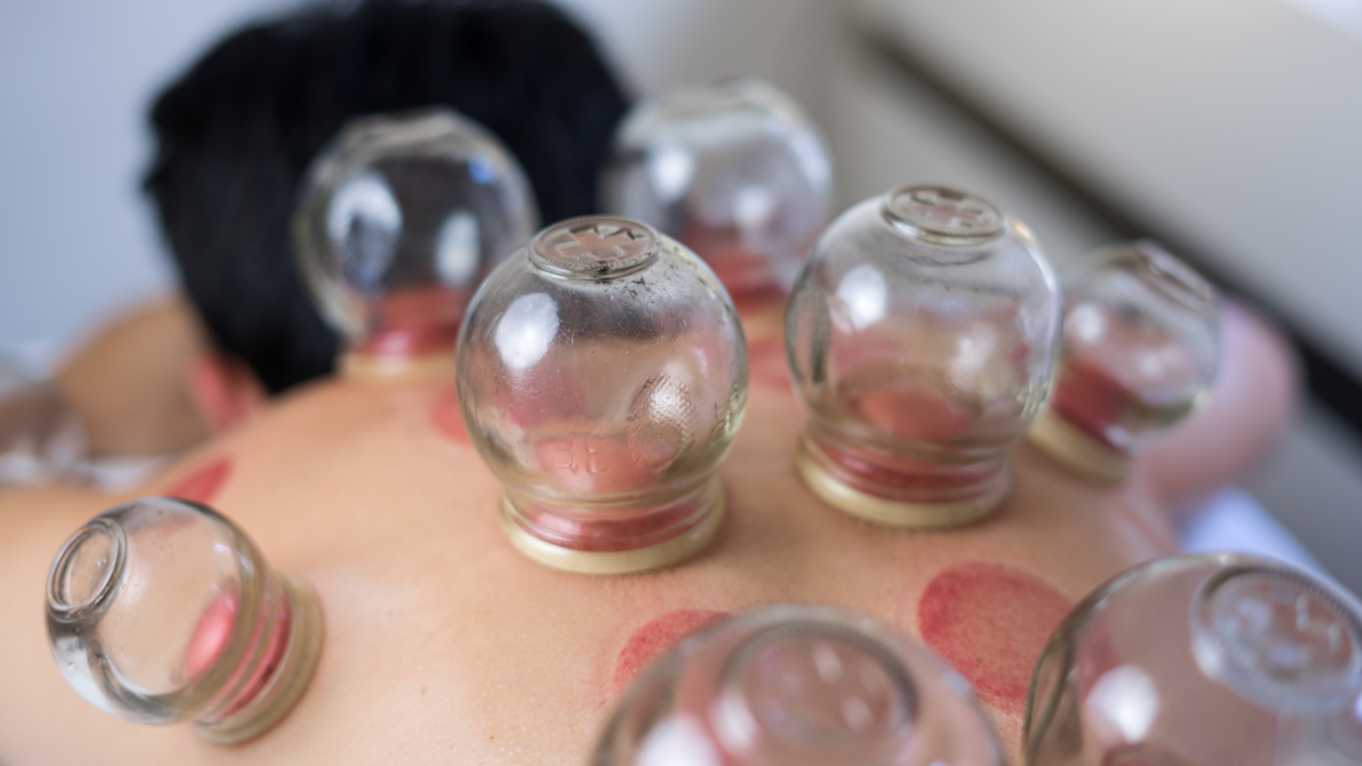Cupping Therapy: The Ancient Healing Secret That’s Back and Better Than ...